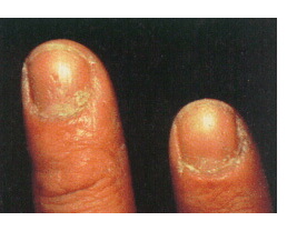 Nail Health - San Diego Dermatologist